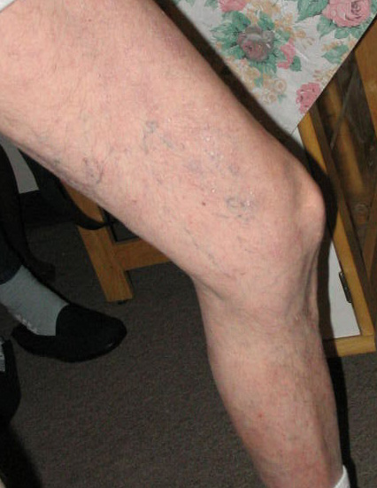 Photo Gallery/Chloramine in Vermont