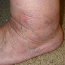 Photo Gallery/Chloramine in Vermont